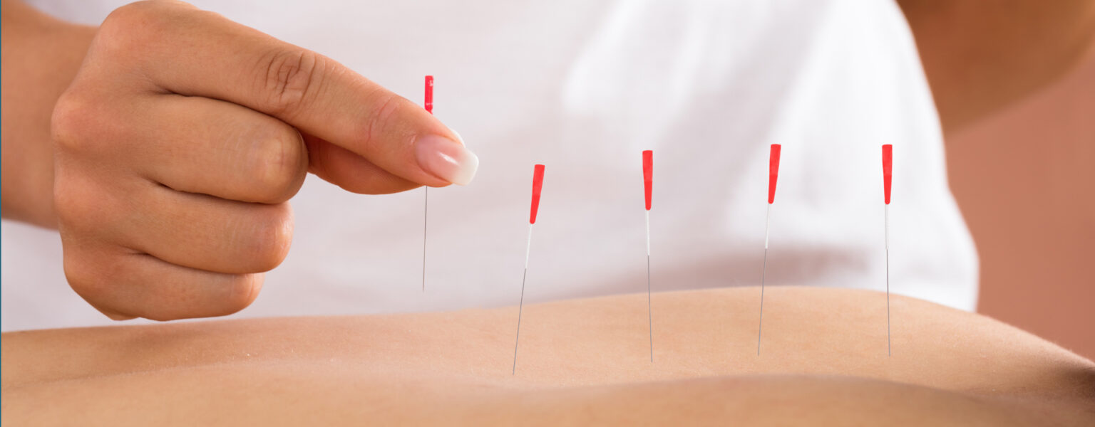 Best Acupuncture Clinic Calgary | Royal Oak Physio