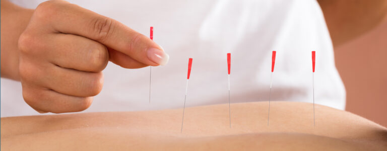 Best Acupuncture Clinic Calgary | Royal Oak Physio